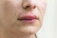 Swelling Angioedema Gupta Allergy Allergy Asthma Specialists